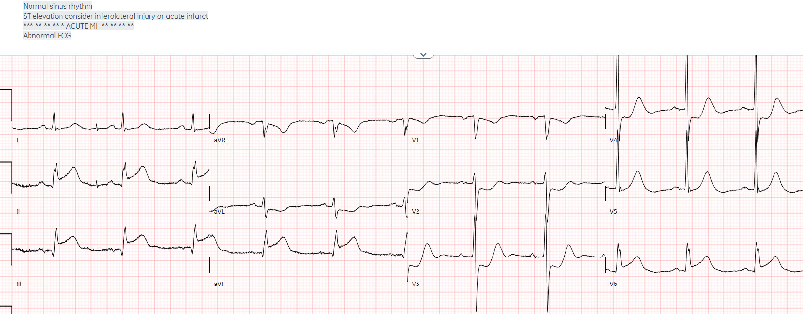 ECG Interpretation in Cocaine Chest Pain - האיגוד הישראלי לרפואה דחופה