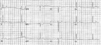 Transient STEMI pitfalls and pearls | ECG Cases | EM Cases
