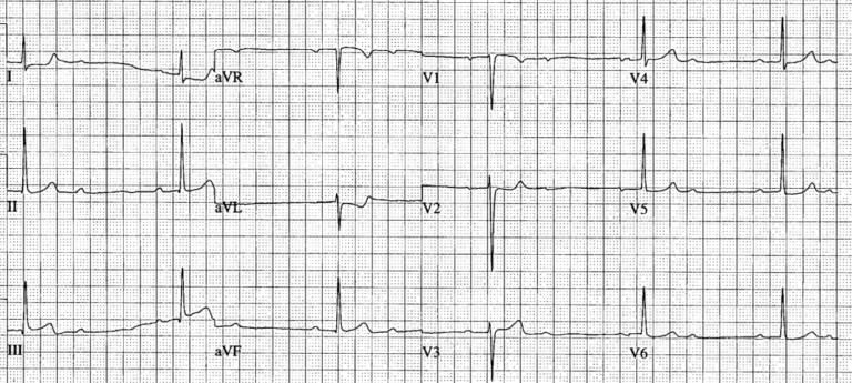 Transient STEMI pitfalls and pearls | ECG Cases | EM Cases