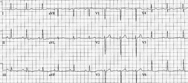 Transient STEMI pitfalls and pearls | ECG Cases | EM Cases