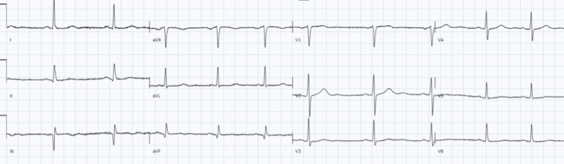 Transient STEMI pitfalls and pearls | ECG Cases | EM Cases