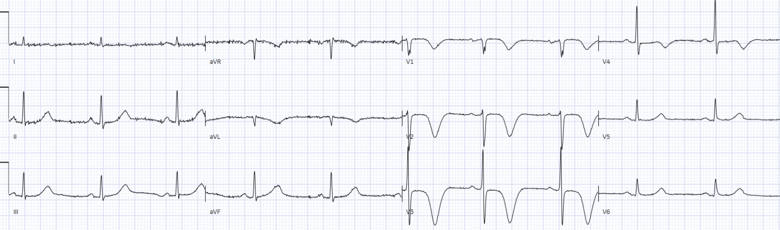 Transient STEMI pitfalls and pearls | ECG Cases | EM Cases