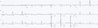 Transient STEMI pitfalls and pearls | ECG Cases | EM Cases