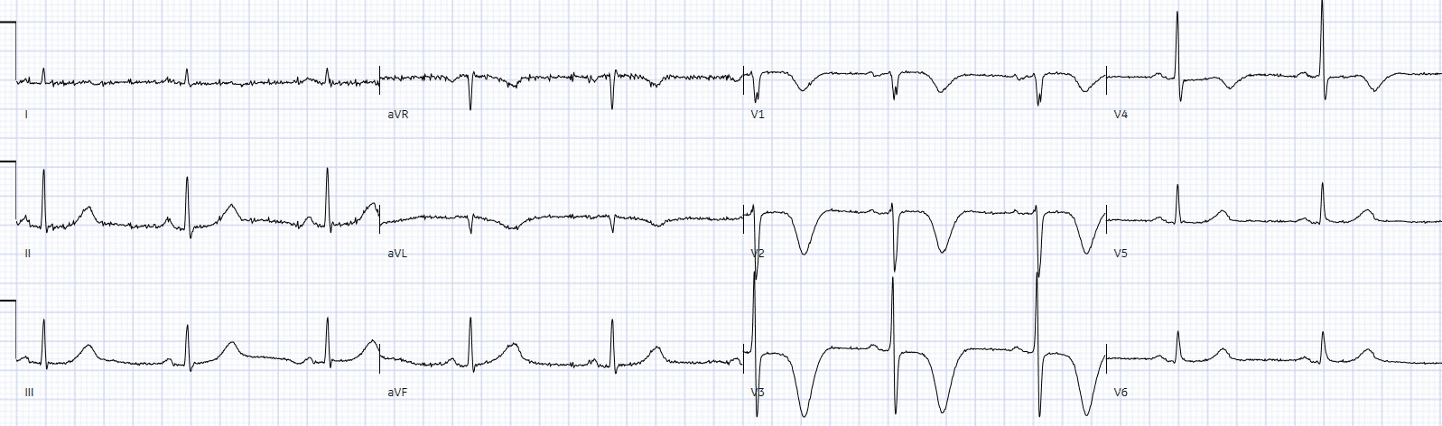 Transient STEMI pitfalls and pearls | ECG Cases | EM Cases