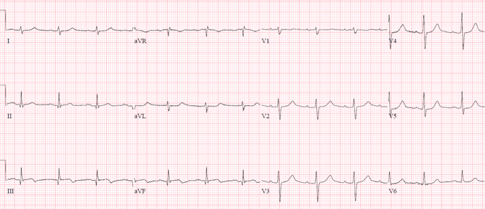 Transient STEMI pitfalls and pearls | ECG Cases | EM Cases