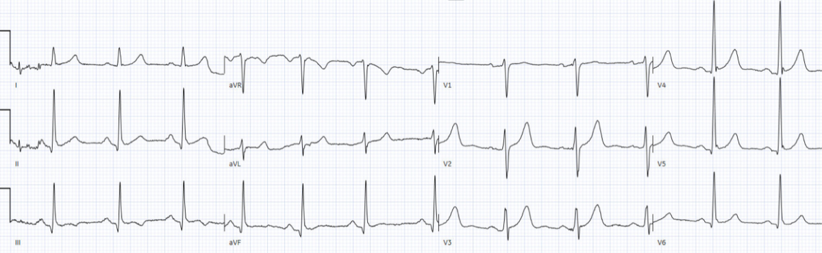 Transient STEMI pitfalls and pearls | ECG Cases | EM Cases