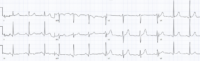 Transient STEMI pitfalls and pearls | ECG Cases | EM Cases