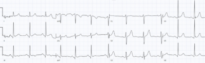 Transient Stemi Pitfalls And Pearls Ecg Cases Em Cases