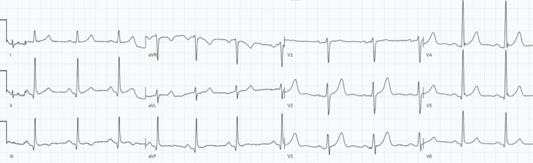 Transient STEMI pitfalls and pearls | ECG Cases | EM Cases