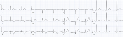 Transient STEMI pitfalls and pearls | ECG Cases | EM Cases