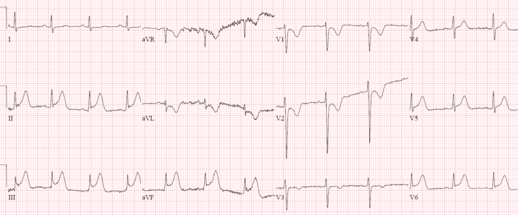 Transient STEMI pitfalls and pearls | ECG Cases | EM Cases