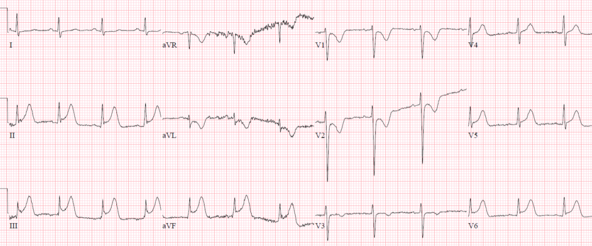 Transient STEMI pitfalls and pearls | ECG Cases | EM Cases
