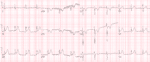 Transient STEMI pitfalls and pearls | ECG Cases | EM Cases