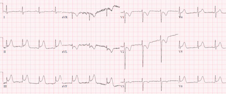 Transient STEMI pitfalls and pearls | ECG Cases | EM Cases