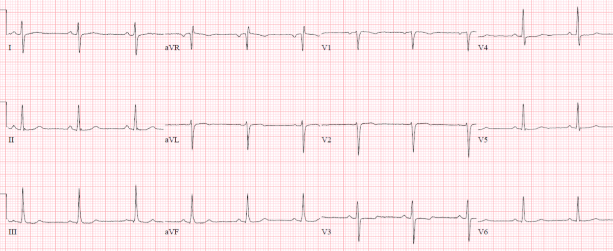 Transient STEMI pitfalls and pearls | ECG Cases | EM Cases