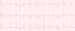 Transient STEMI pitfalls and pearls | ECG Cases | EM Cases