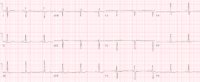 Transient STEMI pitfalls and pearls | ECG Cases | EM Cases