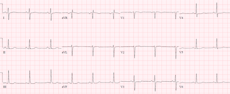 Transient STEMI pitfalls and pearls | ECG Cases | EM Cases