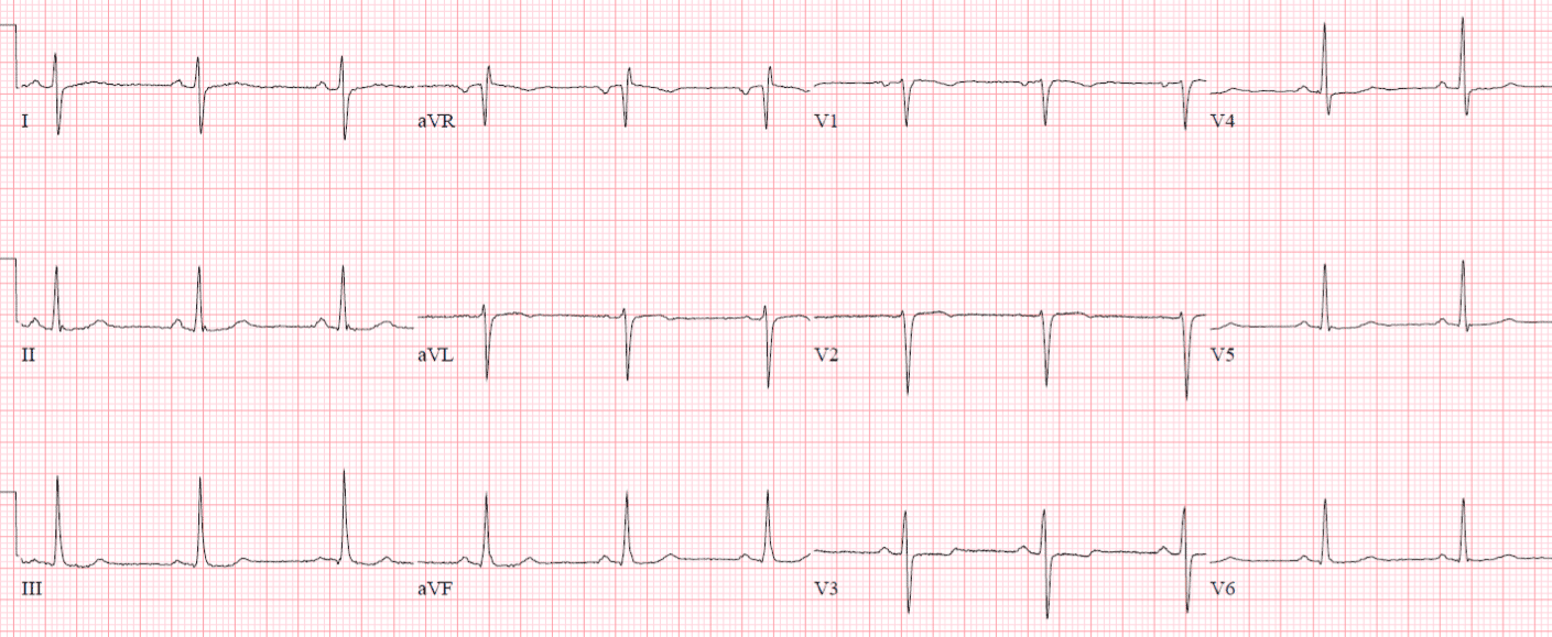 Transient STEMI pitfalls and pearls | ECG Cases | EM Cases