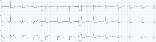 Transient STEMI pitfalls and pearls | ECG Cases | EM Cases