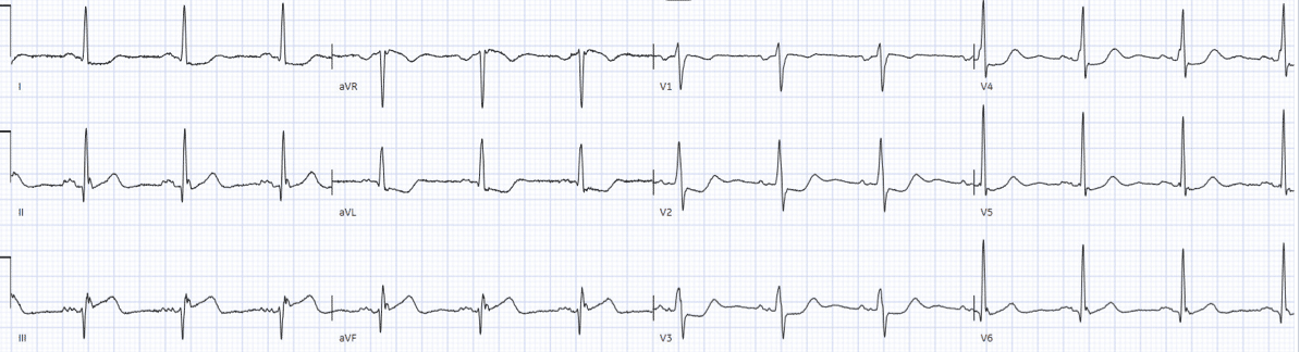 Transient STEMI pitfalls and pearls | ECG Cases | EM Cases