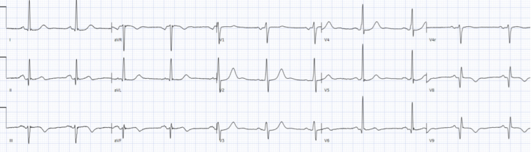 Transient STEMI pitfalls and pearls | ECG Cases | EM Cases