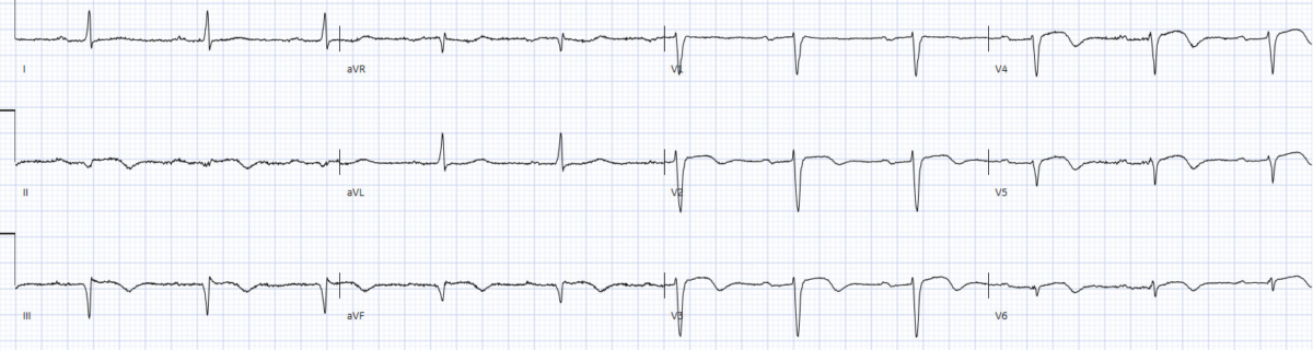 Transient STEMI pitfalls and pearls | ECG Cases | EM Cases
