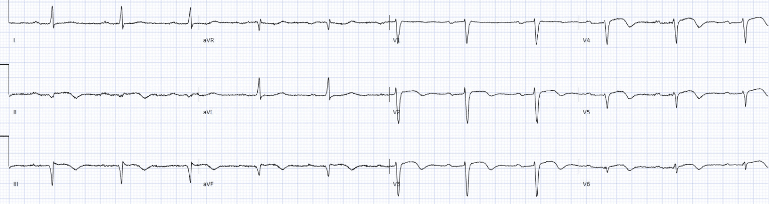 Transient STEMI pitfalls and pearls | ECG Cases | EM Cases