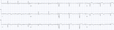 Transient STEMI pitfalls and pearls | ECG Cases | EM Cases