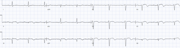 Transient STEMI pitfalls and pearls | ECG Cases | EM Cases
