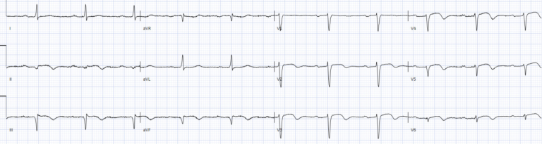 Transient STEMI pitfalls and pearls | ECG Cases | EM Cases
