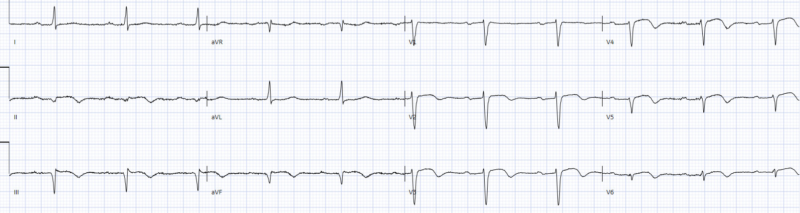 Transient STEMI pitfalls and pearls | ECG Cases | EM Cases