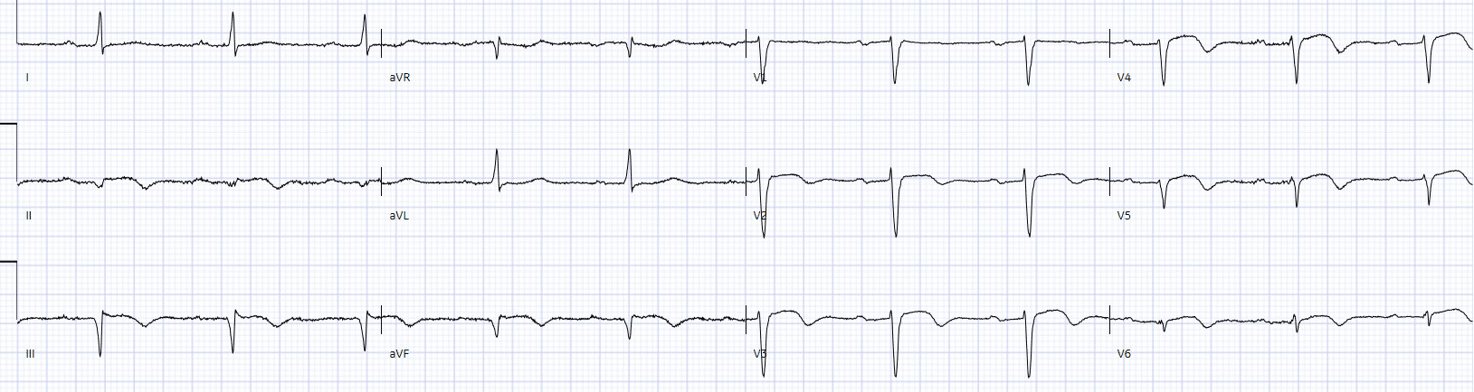 Transient STEMI pitfalls and pearls | ECG Cases | EM Cases