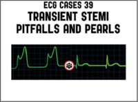 Transient STEMI pitfalls and pearls | ECG Cases | EM Cases