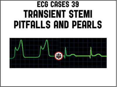 Transient STEMI pitfalls and pearls | ECG Cases | EM Cases