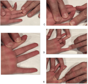Hand Injuries - Pitfalls in Assessment | Emergency Medicine Cases