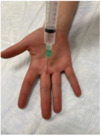 Hand Injuries - Pitfalls in Assessment | Emergency Medicine Cases