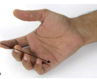 Hand Injuries - Pitfalls in Assessment | Emergency Medicine Cases