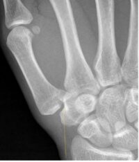 Hand Injuries - Finger Tip Injuries, Jersey Finger, PIP Dislocations ...