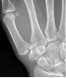 Hand Injuries - Finger Tip Injuries, Jersey Finger, PIP Dislocations ...