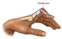 Hand Injuries - Finger Tip Injuries, Jersey Finger, PIP Dislocations ...