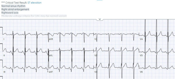 Approach to Spontaneous Coronary Artery Dissection (SCAD) | EM Cases