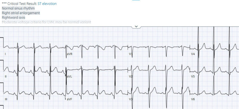 Approach to Spontaneous Coronary Artery Dissection (SCAD) | EM Cases