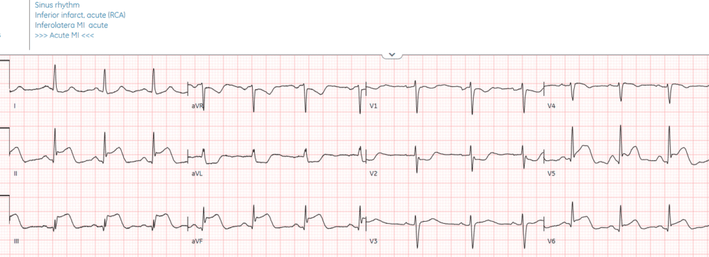 Approach to Spontaneous Coronary Artery Dissection (SCAD) | EM Cases