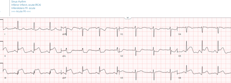 Approach to Spontaneous Coronary Artery Dissection (SCAD) | EM Cases