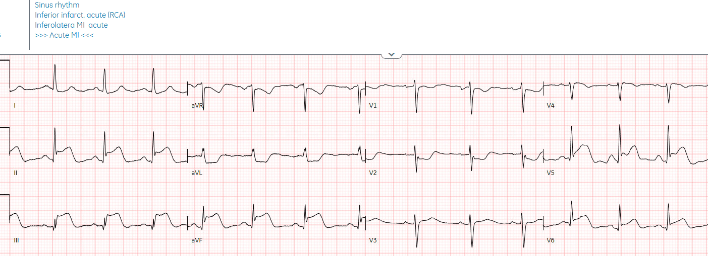 Approach to Spontaneous Coronary Artery Dissection (SCAD) | EM Cases