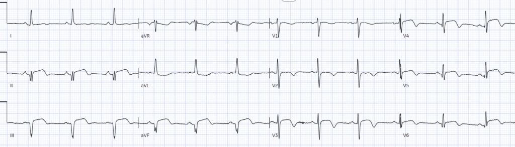 Approach to Spontaneous Coronary Artery Dissection (SCAD) | EM Cases