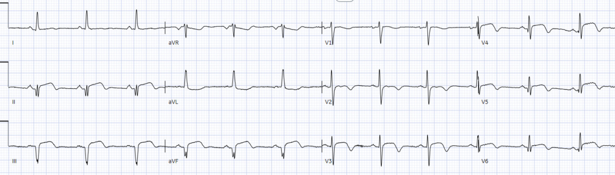 Approach to Spontaneous Coronary Artery Dissection (SCAD) | EM Cases