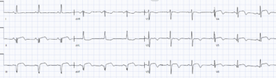 Approach to Spontaneous Coronary Artery Dissection (SCAD) | EM Cases