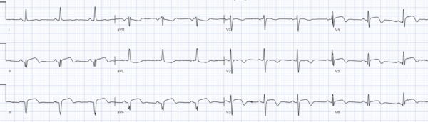 Approach to Spontaneous Coronary Artery Dissection (SCAD) | EM Cases